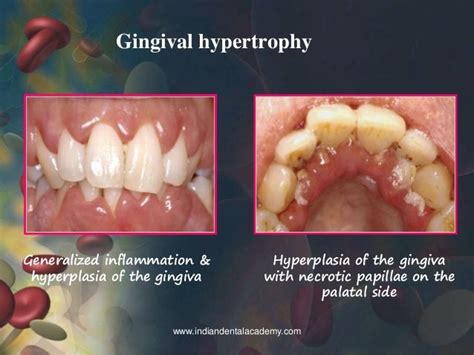 Leukemia Dental Implant Courses
