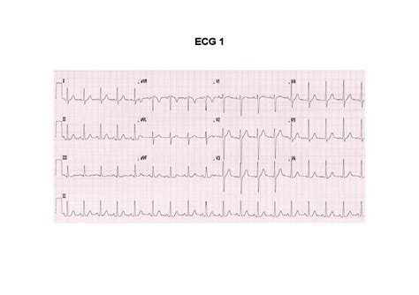 Ecg Quiz 31 Ecg Interpretations Ecg 1 Normal Sinus Rhythm Ecg 2