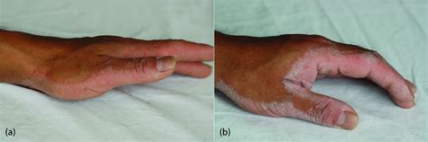 Aquagenic Cutaneous Disorders Wang 2017 Jddg Journal Der