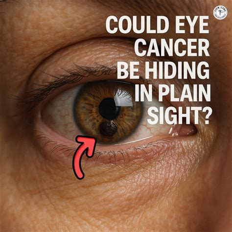 Eye Cancer Signs Risks And Treatment Options By Dr Garg