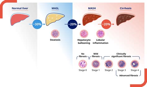 Mash Resources For Hcps Mash Awareness