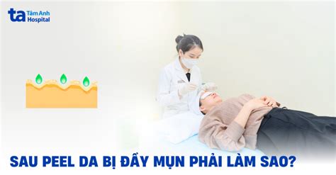 Peel Da Mặt Có Tốt Không Ưu Nhược điểm Và Có Tác Dụng Gì