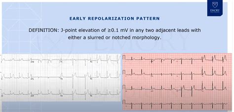 All That Follows Below Are Slides From Early Repolarization Syndrome