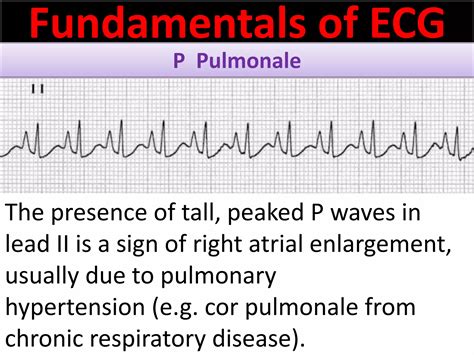 P Wave Abnormalities In Ecg Ppsx