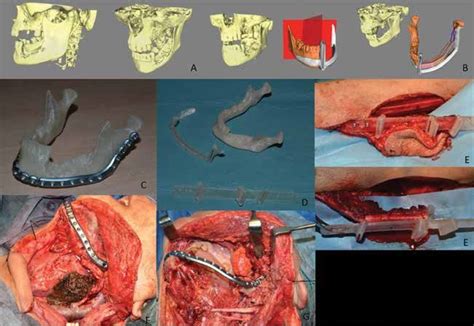 A Virtual Simulation Of The Initial Mandibular Defect B Virtual Design