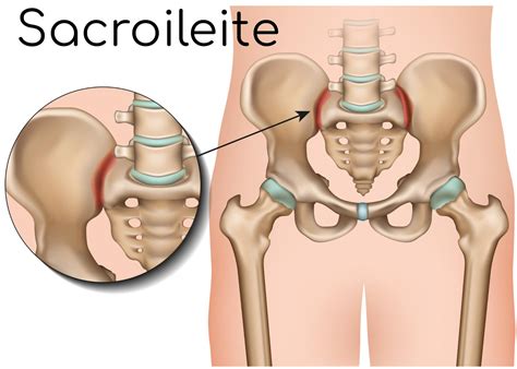 Sacroileite Cause Sintomi E Cura