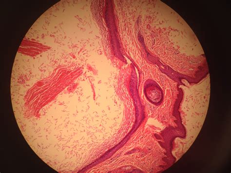 Any Advice On Possible Acantholytic Feature In Epidermal Inclusion Cyst