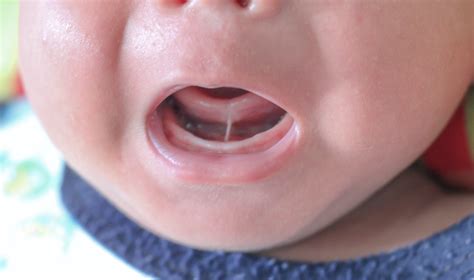 Conditions Of The Oral Cavity Mouth