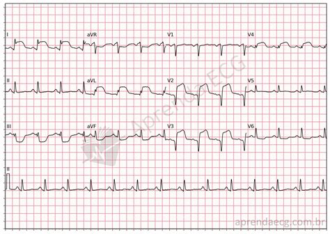Padrão De Supradesnivelamento De St Em Lápide Tombstone Aprenda Ecg