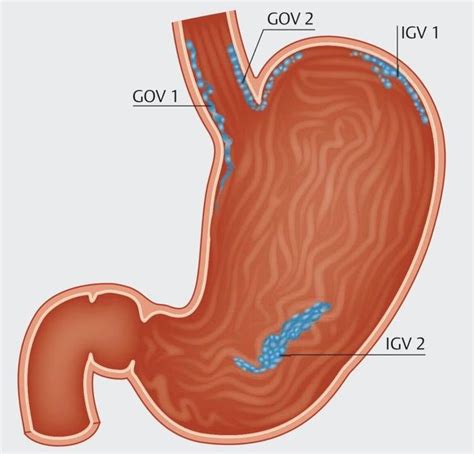 Sarin Classification Of Gastric Varices Gastroenterology Hemorrhage Gastrointestinal