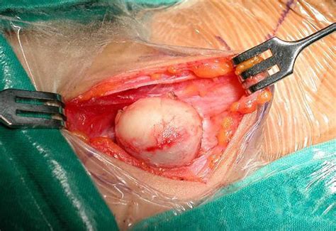 File Surgery Of Suprasternal Epidermoid Cyst  Wikipedia