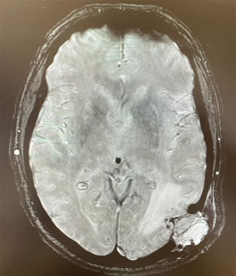 Mrsa Abscess Occurring After Left Occipital Craniotomy Mri Sequences Download Scientific