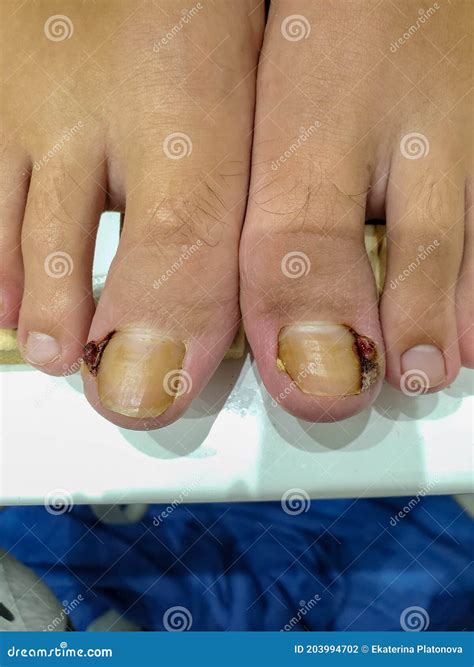 Close Up Of Toes Ingrown Toenail Problem Beginning Of Healing Of An