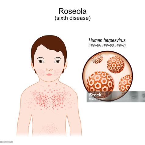 Roseola Sixth Disease Infectious Disease Human Herpes Viruses Stock