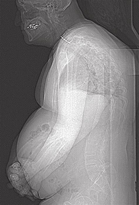 Fixed Flexion Deformity Of Cervical Spine And Severely Decreased Download Scientific Diagram