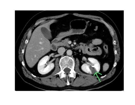 Imaging Case Of The Week 529 Answer Emergucate