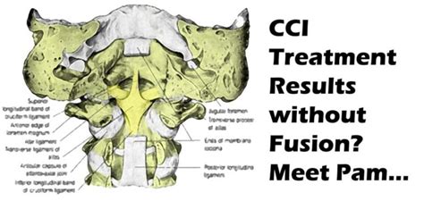 Craniocervical Instability Treatment ~ Pams Story