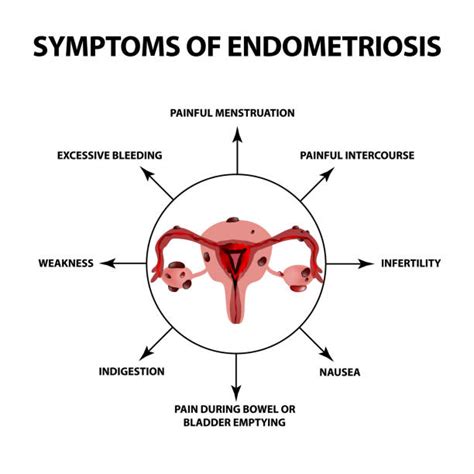 Endometriosis Illustrations Royalty Free Vector Graphics And Clip Art