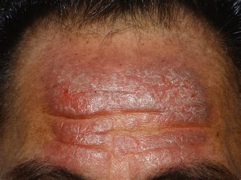 Eczema On Scrotum
