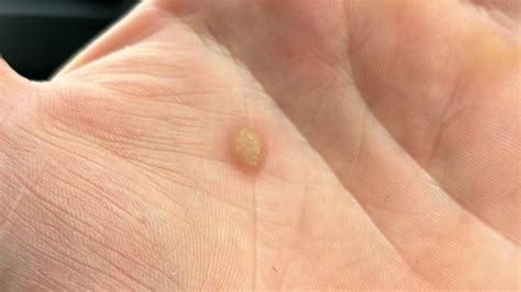 Wart Causes And Prevention Expert Tips For Clear Skin