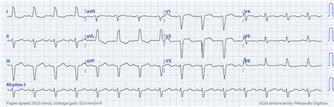 Em Ronin Pathologic Vs Benign Q Waves On Ecg