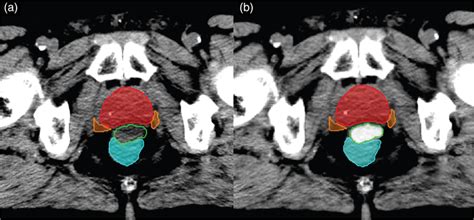 An Illustration Of Spacer Computed Tomography CT Intensity Override