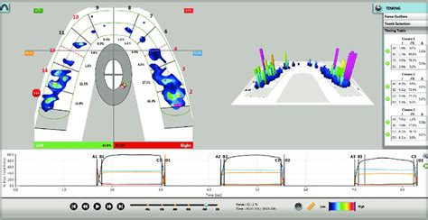 Maximum Intercuspation T Scan Data Before Disclusion Time Reduction