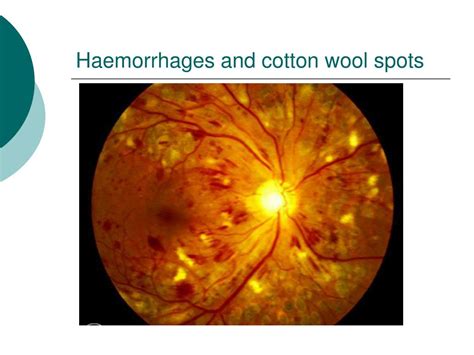 Ppt Diabetic Retinopathy Dr Powerpoint Presentation Free Download