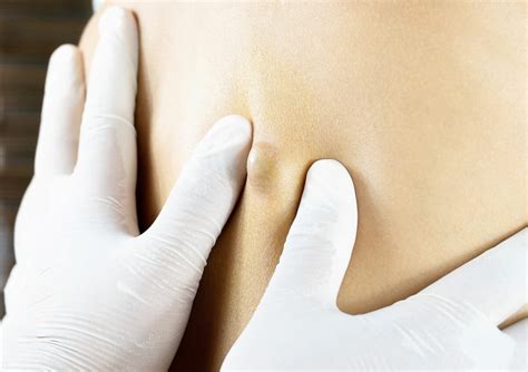 Cyst Removal Surgery Minimally Invasive Technique Apax Medical