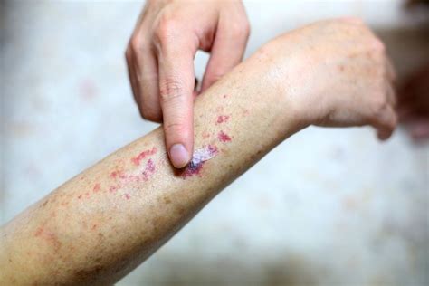 Petechiae Causes Pictures And When To Worry