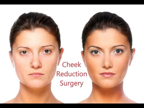 Cheek Reduction Surgery Procedure