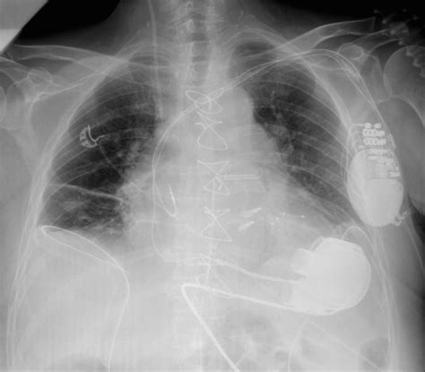 Use Of Lvad Heartmate 3 And Impella Rp In The Management Of Advanced