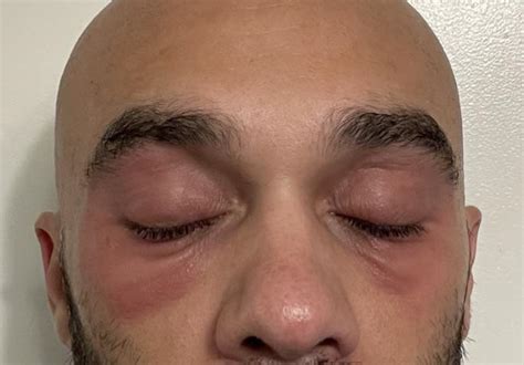 Allergic Reaction Face And Eyes Swollen