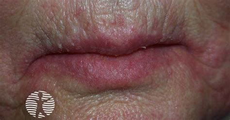 Angular Cheilitis Image
