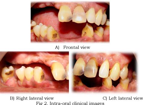 Figure 2 From Prosthodontic Rehabilitation Using Broadrick Flag