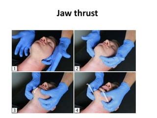 Basic Airway Managementpptx