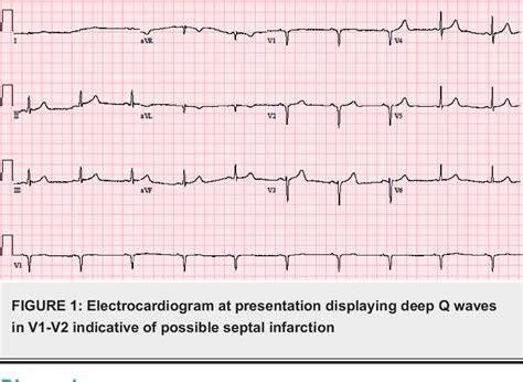 Figure 1 From A Pseudo Infarction Pattern In The Setting Of Esophageal Malignancy Semantic Scholar