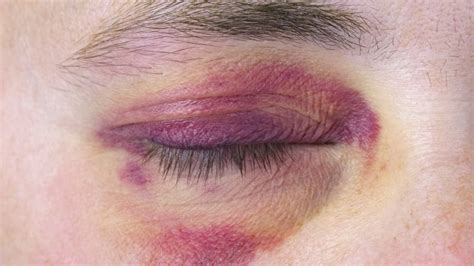 How Do I Help A Black Eye Heal Angies List