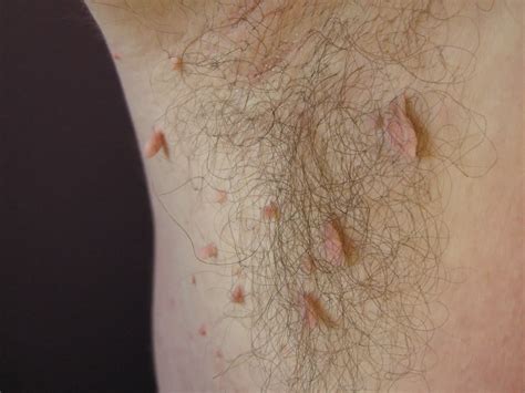 Skin Tag Causes Symptoms And Treatment Options