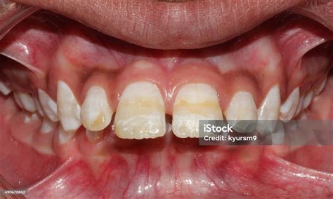 Understanding Fluorosiscauses Symptoms Prevention Treatment