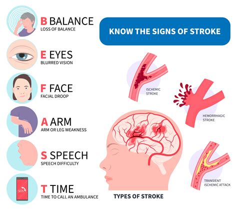 Stroke Symptoms Face