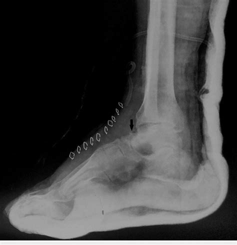 Post Operative Lateral Radiograph Of The Ankle And Hindfoot