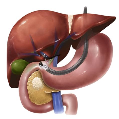 Ercp And Endoscopic Ultrasound Eus Complementary Tools In Gastroenterology