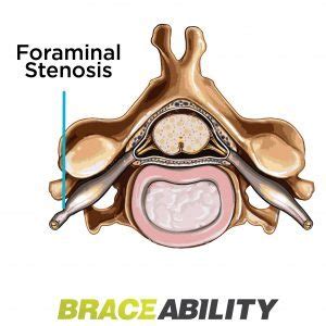 Are Central Foraminal And Lateral Spinal Stenosis All Different