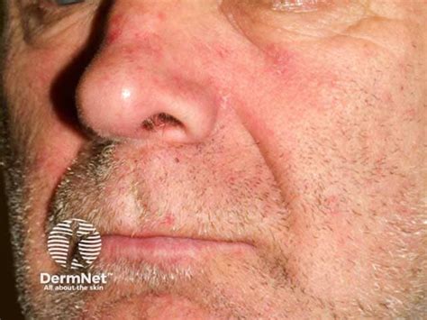 Seborrhoeic Dermatitis Images — Dermnet