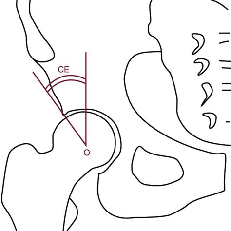 11 Disruption Of The Chondrolabral Junction On Mra Coronal T1wi With