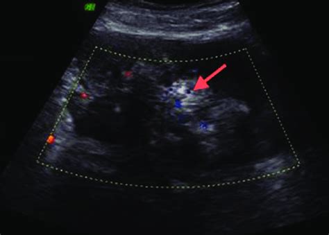 A Transverse Ultrasound Of The Pelvis Reveals A Polypoidal Mass In The Download Scientific