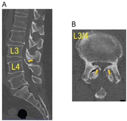 Pseudomeningocele Presenting With Neurological Symptoms 1 Year After