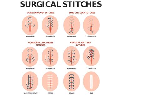 Types Of Suture No 1 Suture Surgical Manufacturer In China