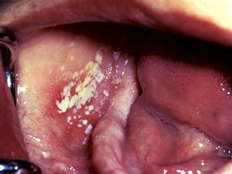 Candidiasis